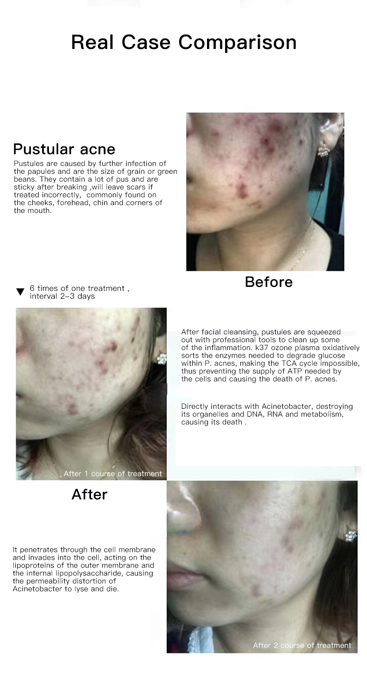 Upgrade ozone plasma pen 2nd generation - Ibeier Technology