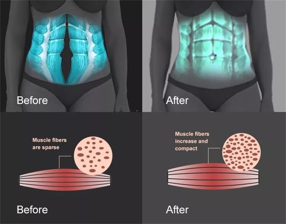 Buy Neo Emsculpt Machine Muscle Builder Online - Ibeier Technology