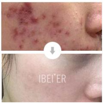Fibroblast K85 Plasma Pen Lifting Neck Tightening Skin Removing Mole ...