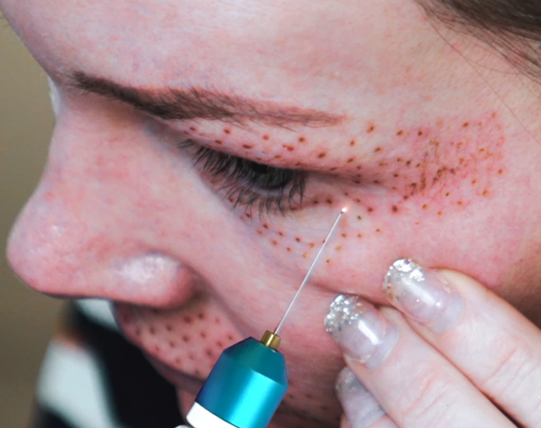 Best Best Fibroblast Plasma Pen - Ibeier Technology