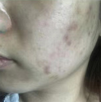 Best Fibroblast Ozone Plasma Pen Skin Treatment - Ibeier Technology