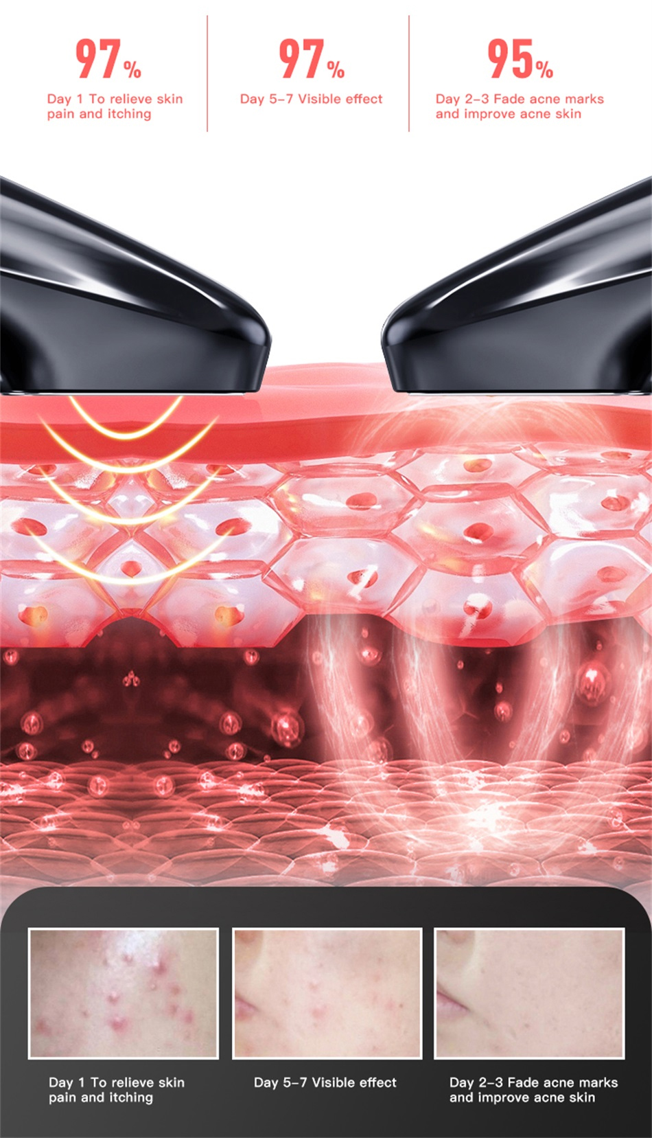 Best Fibroblast Ozone Plasma Pen Skin Treatment - Ibeier Technology