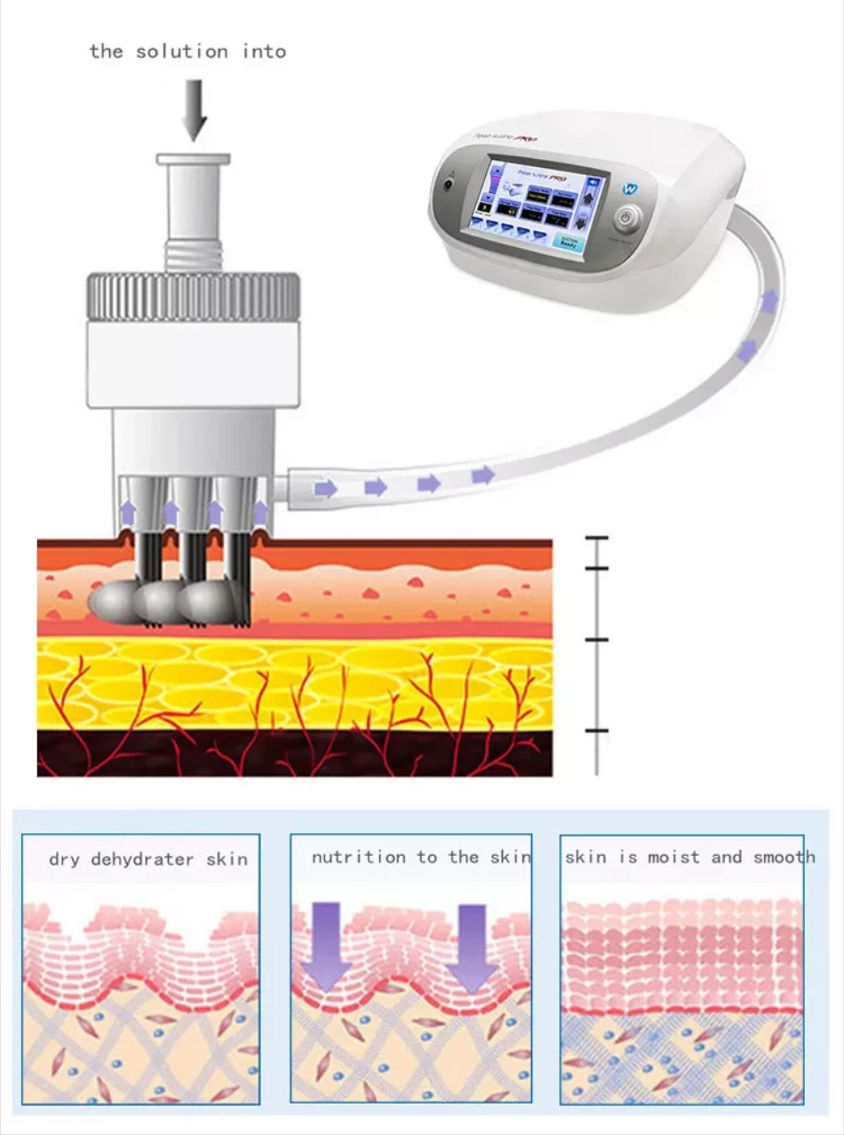 Professional Electroporation Face Mesotherapy Machine - Ibeier Technology