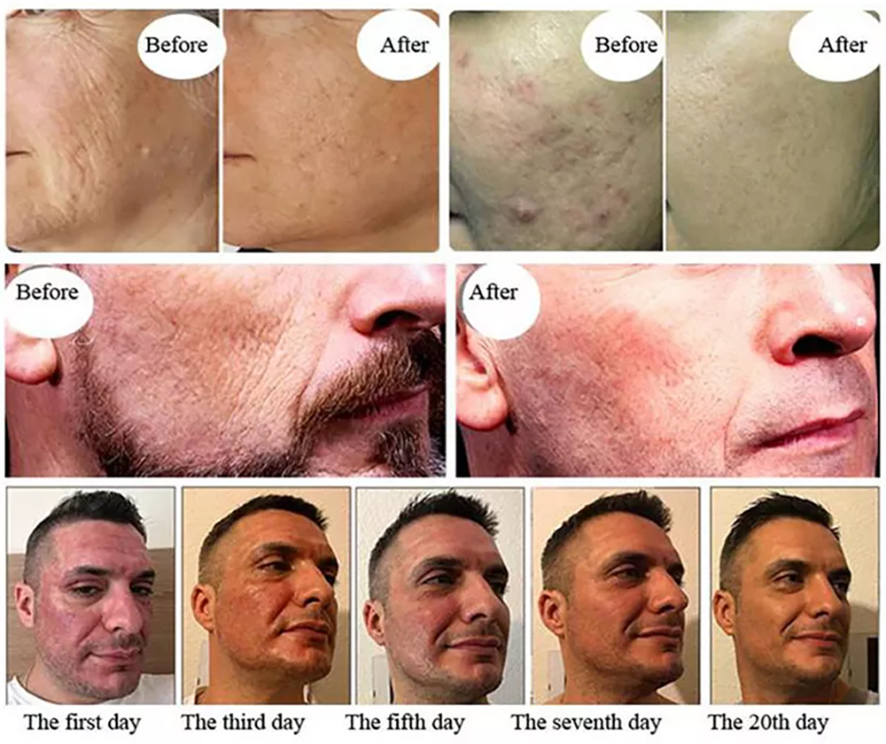 Tixel Machine Treatment Safe - Ibeier Technology