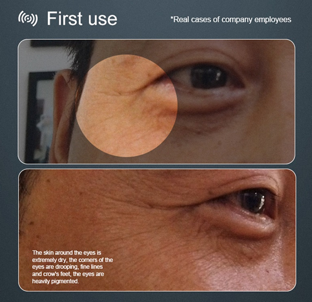 Small Fractional Rf Home Machine Facial Firming - Ibeier Technology