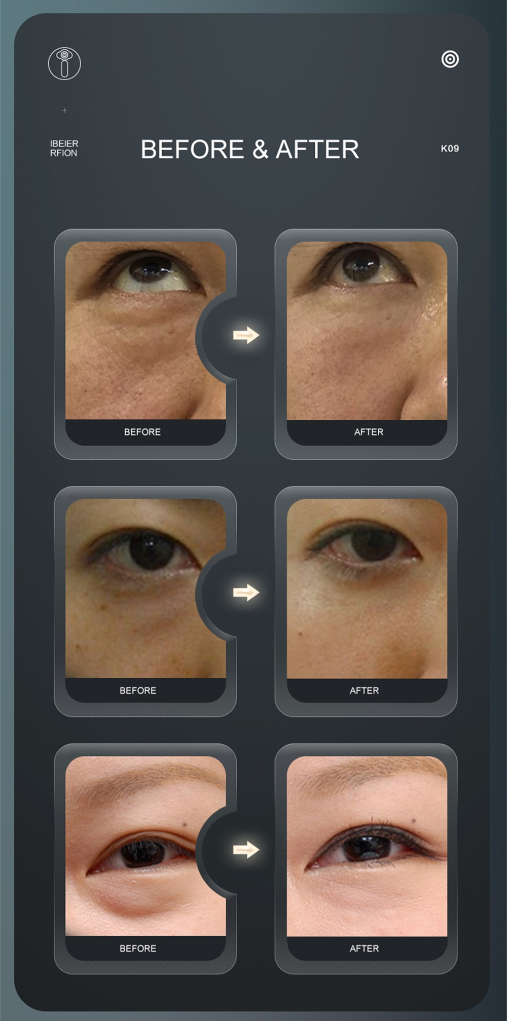 Small Fractional Rf Home Machine Facial Firming - Ibeier Technology