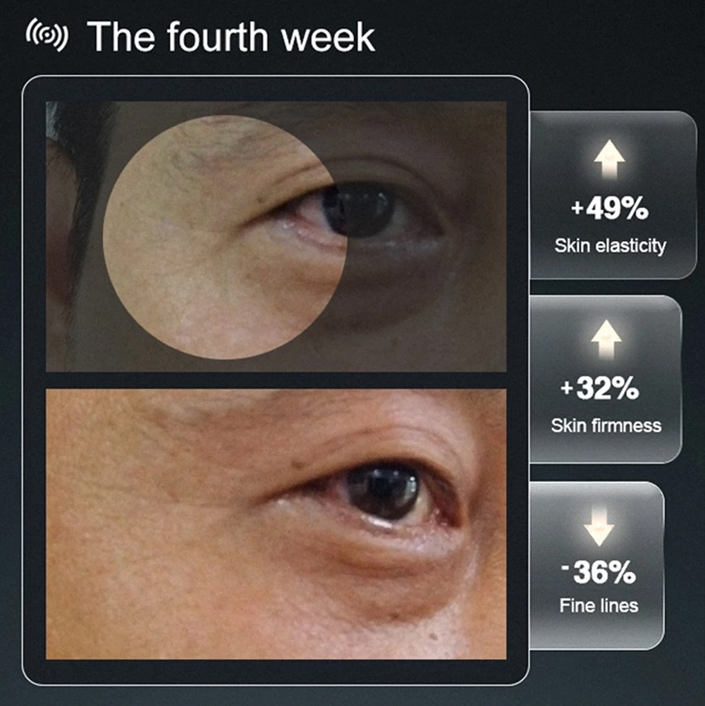 Best at Home Radio Frequency Machine - Ibeier Technology