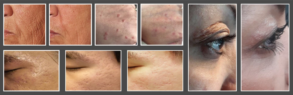 Cold Plasma Machine - Ibeier Technology