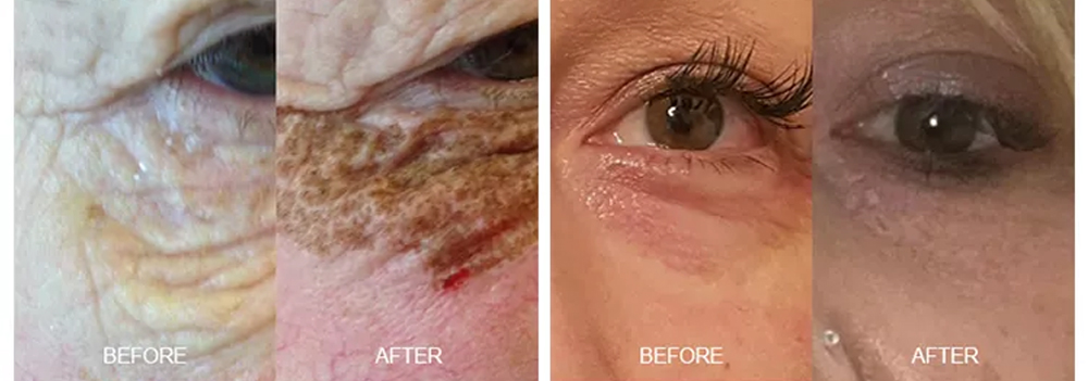 Plasma Pen Eyes - Ibeier Technology