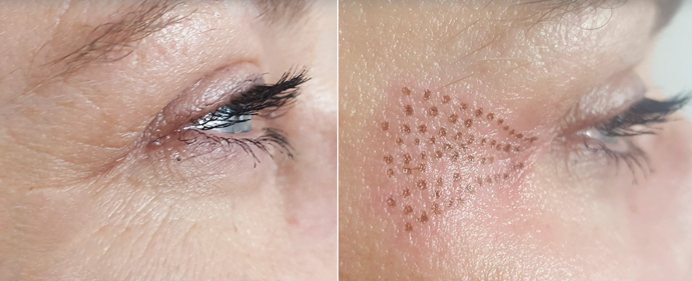 Plasma Pens - Ibeier Technology