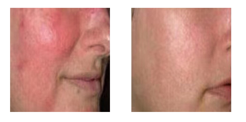 Plasma Ozone Therapy Now - Ibeier Technology