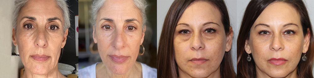 Jet Plasma Pen - Ibeier Technology